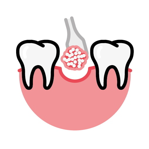 Dental Bone Grafting • Synergy Dental Clinic
