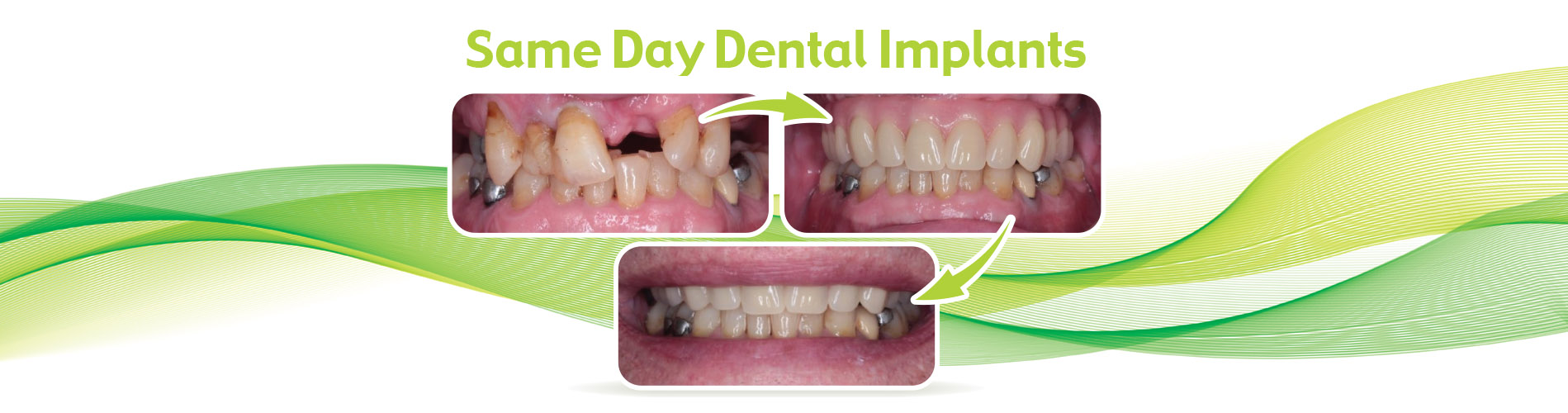 Dental Implants Treatment • Synergy Dental Clinic