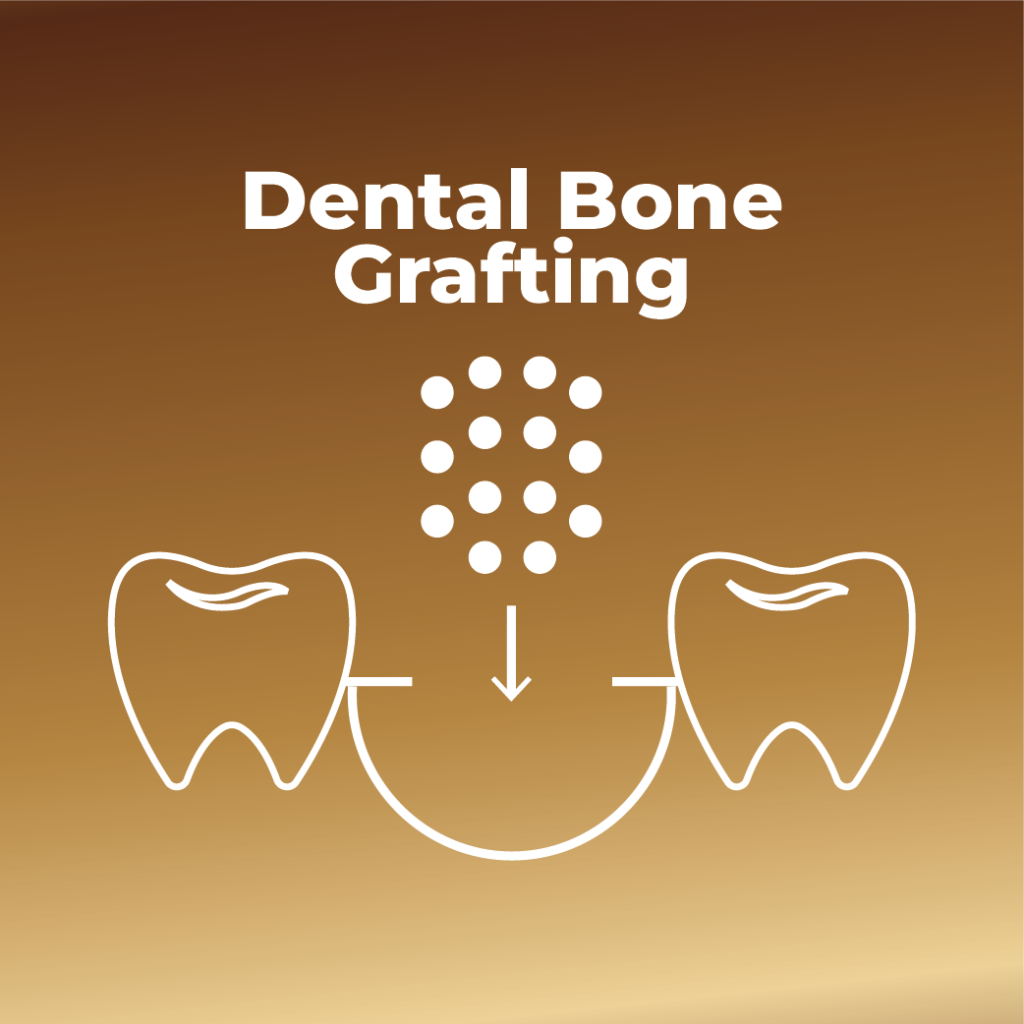 Dental Bone Grafting • Synergy Dental Clinic