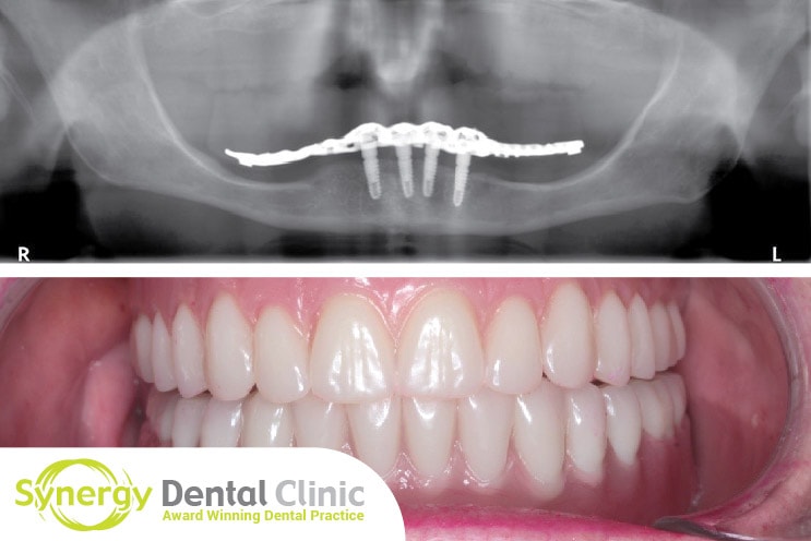 Case Study: Do Your Dentures Make You Feel Insecure? • Synergy Dental ...