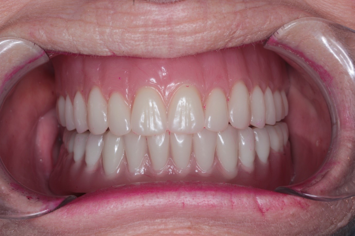 Case Study: Do Your Dentures Make You Feel Insecure? • Synergy Dental ...
