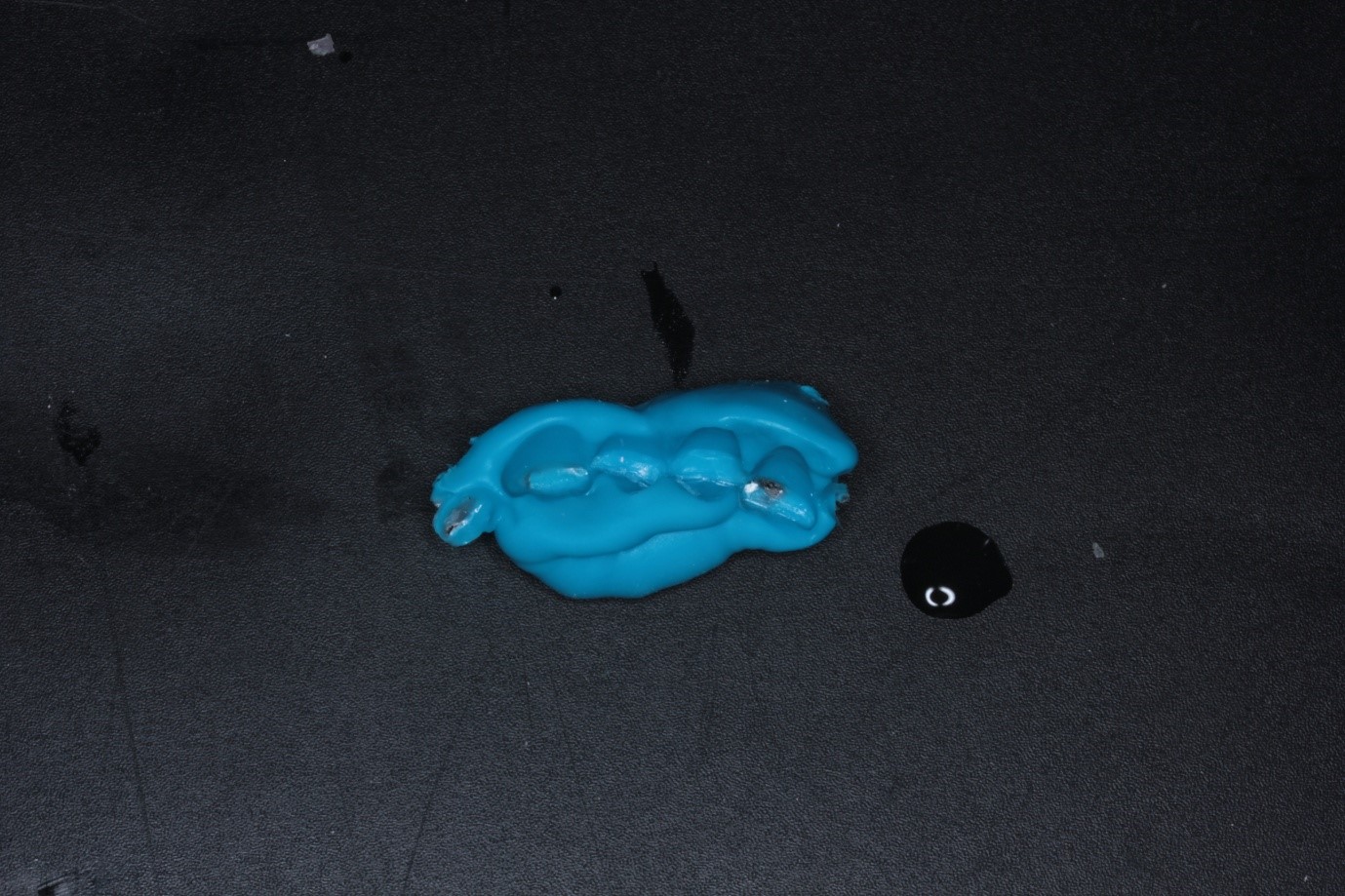 Case Study: The Ins and Outs of Implant Surgery • Synergy Dental Clinic