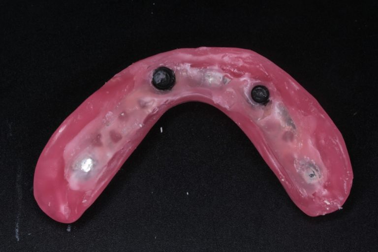 Implant Retained Overdentures Case 3 • Synergy Dental Clinic