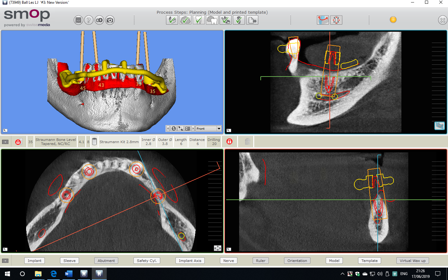 Case Study: Implants and Patient Confidence • Synergy Dental Clinic