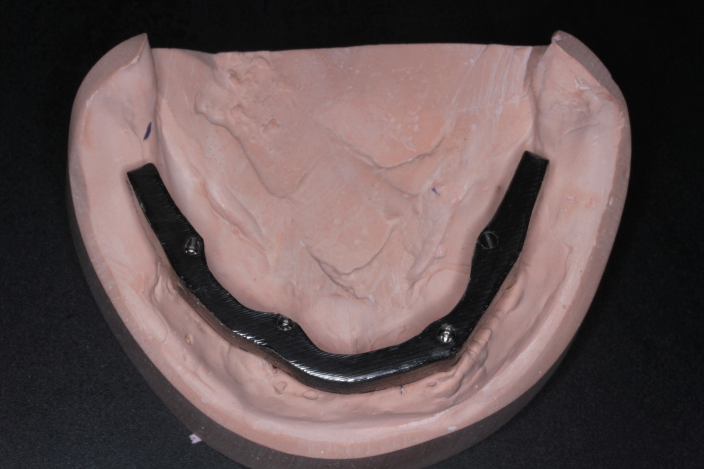 Case Study: Implants and Patient Confidence • Synergy Dental Clinic