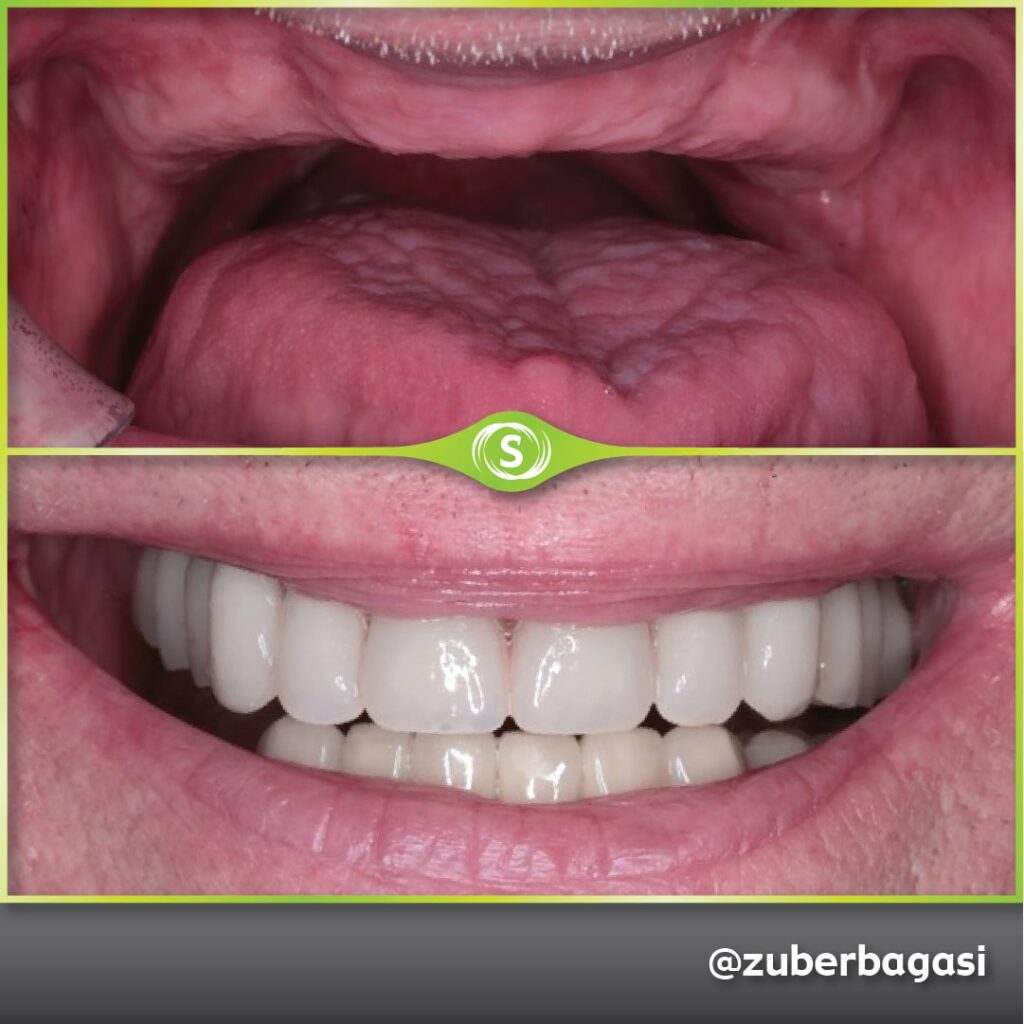 Before and After Full Same Day Implants – Synergy Dental Clinic