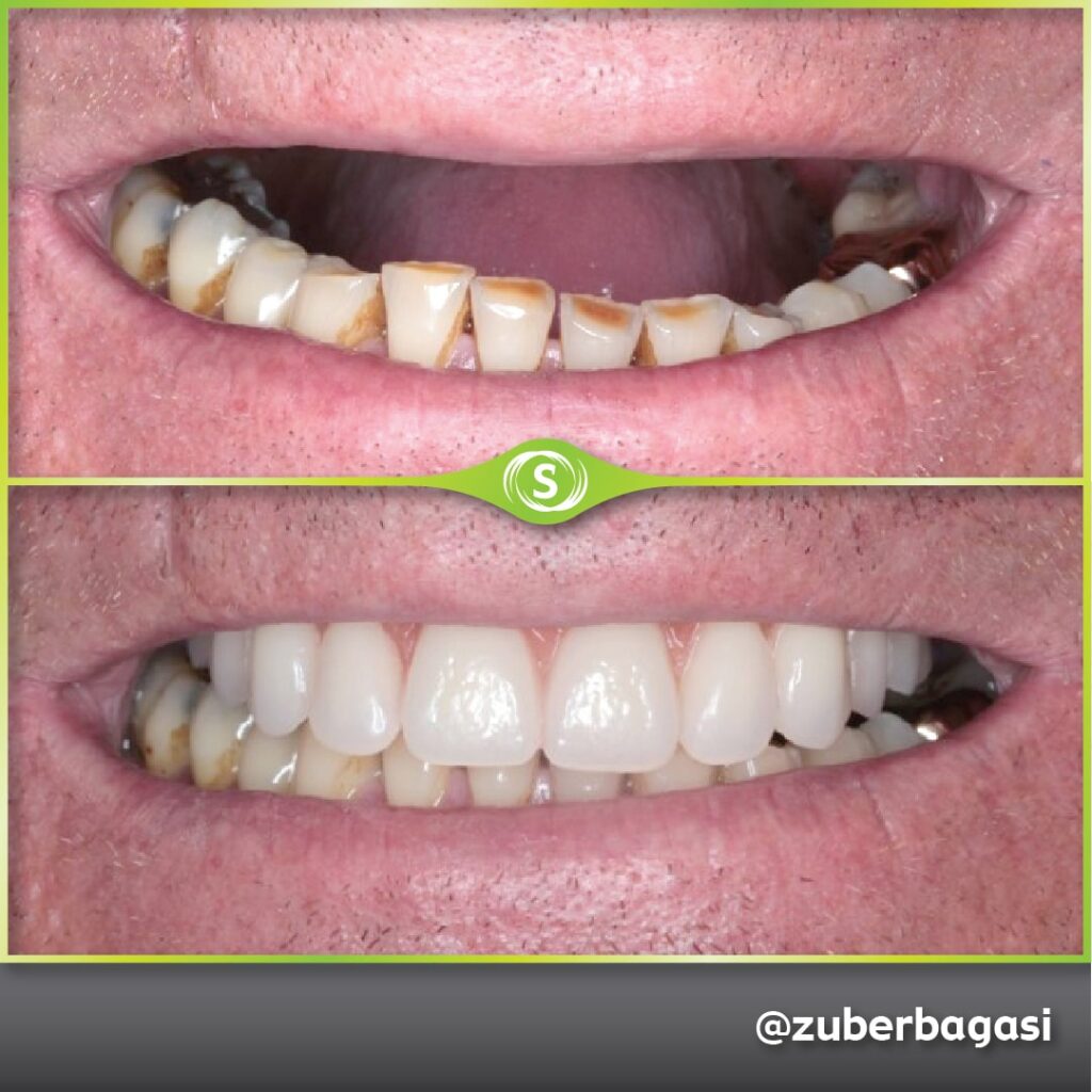 Before and After Full Same Day Implants • Synergy Dental Clinic