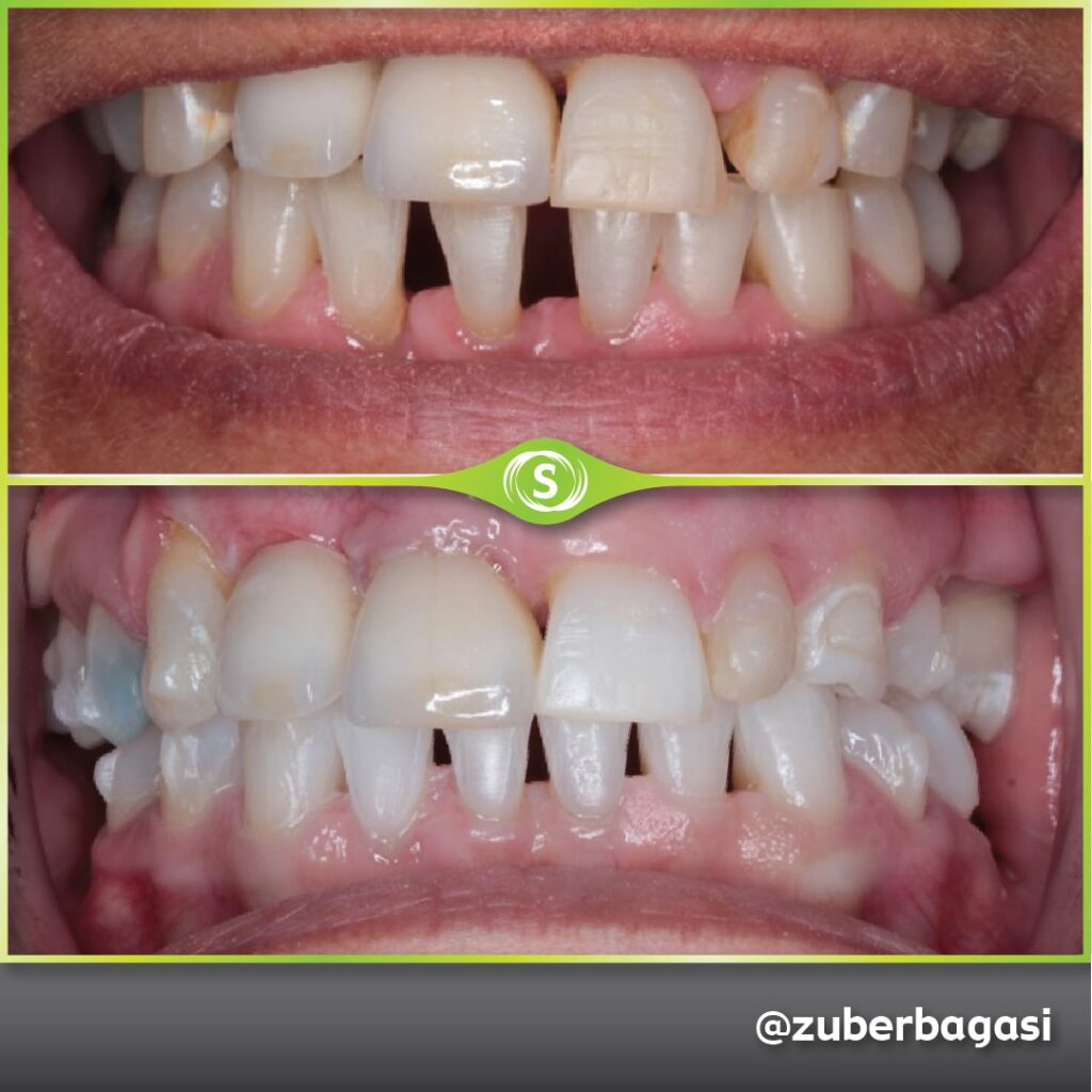 Before and After Teeth Straightening • Synergy Dental Clinic
