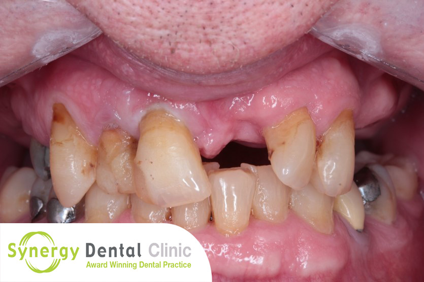 Implant Case Study: My Teeth Are Rotting Away! • Synergy Dental Clinics