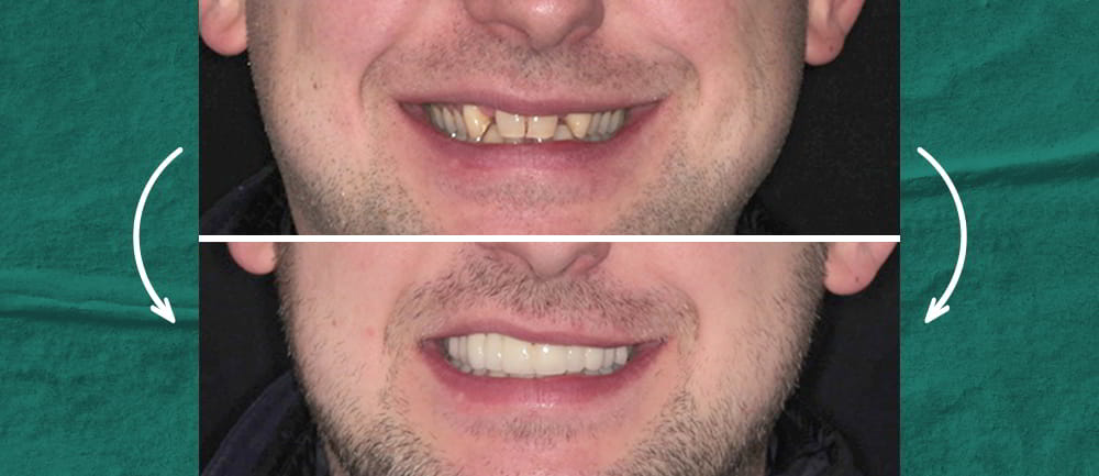 Cosmetic Case Study - Too Many Gaps! • Synergy Dental Clinic