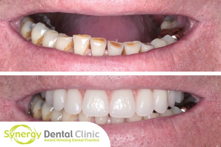 Case Study: New Teeth with Full-Arch Implants • Synergy Dental Clinic