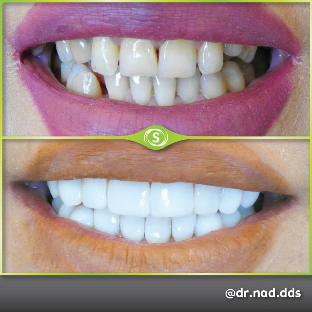 Before and After Composite Bonding Cases • Synergy Dental Clinics
