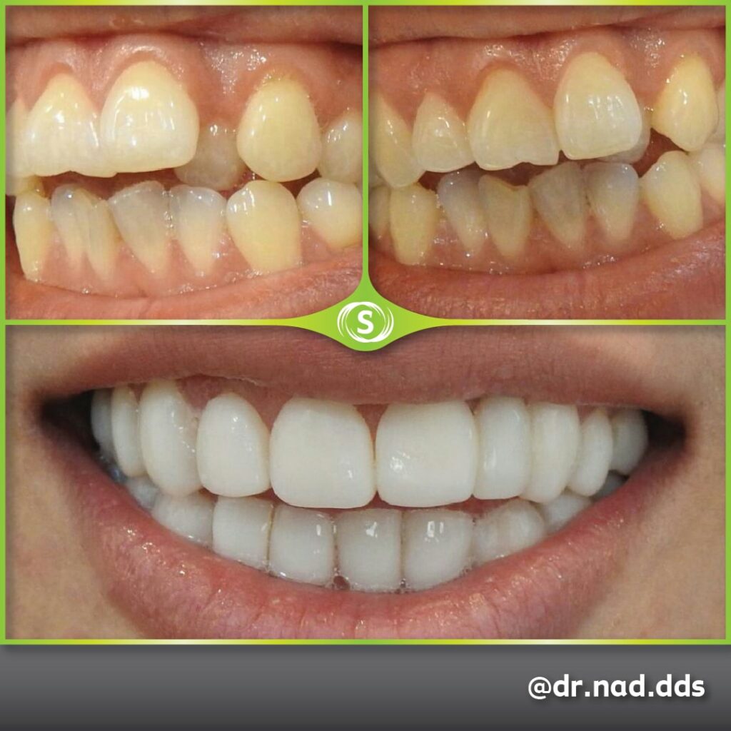 Before and After Composite Bonding Cases • Synergy Dental Clinics