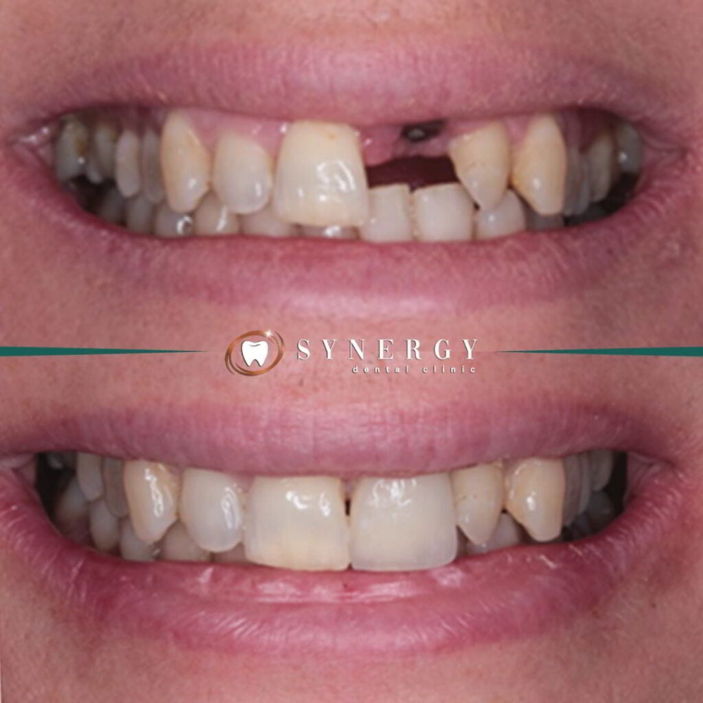 Before and After Dental Implants • Synergy Dental Clinic