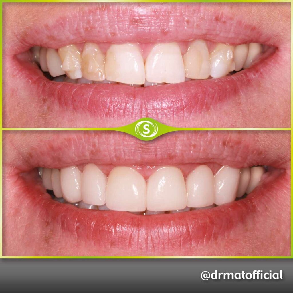 Before and After Composite Bonding Cases • Synergy Dental Clinics