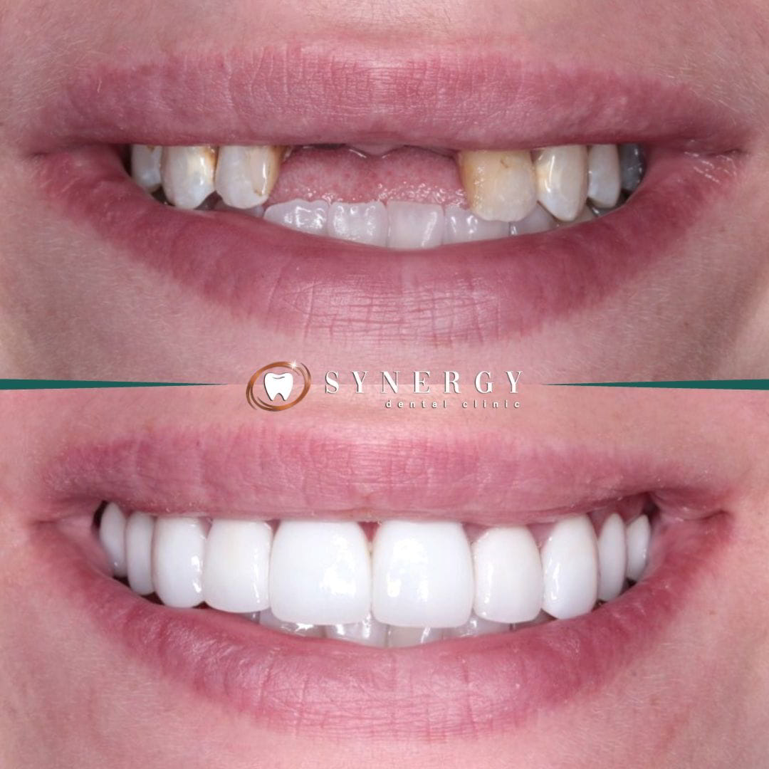 Dr. Zuber Bagasi – Synergy Blackpool – Single implant • Synergy Dental ...