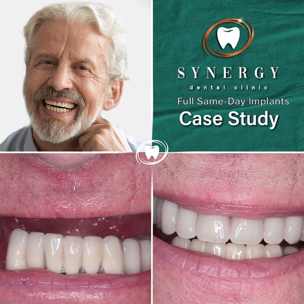 Dr. Zuber Bagasi - Synergy Blackpool - Same day implants • Synergy ...