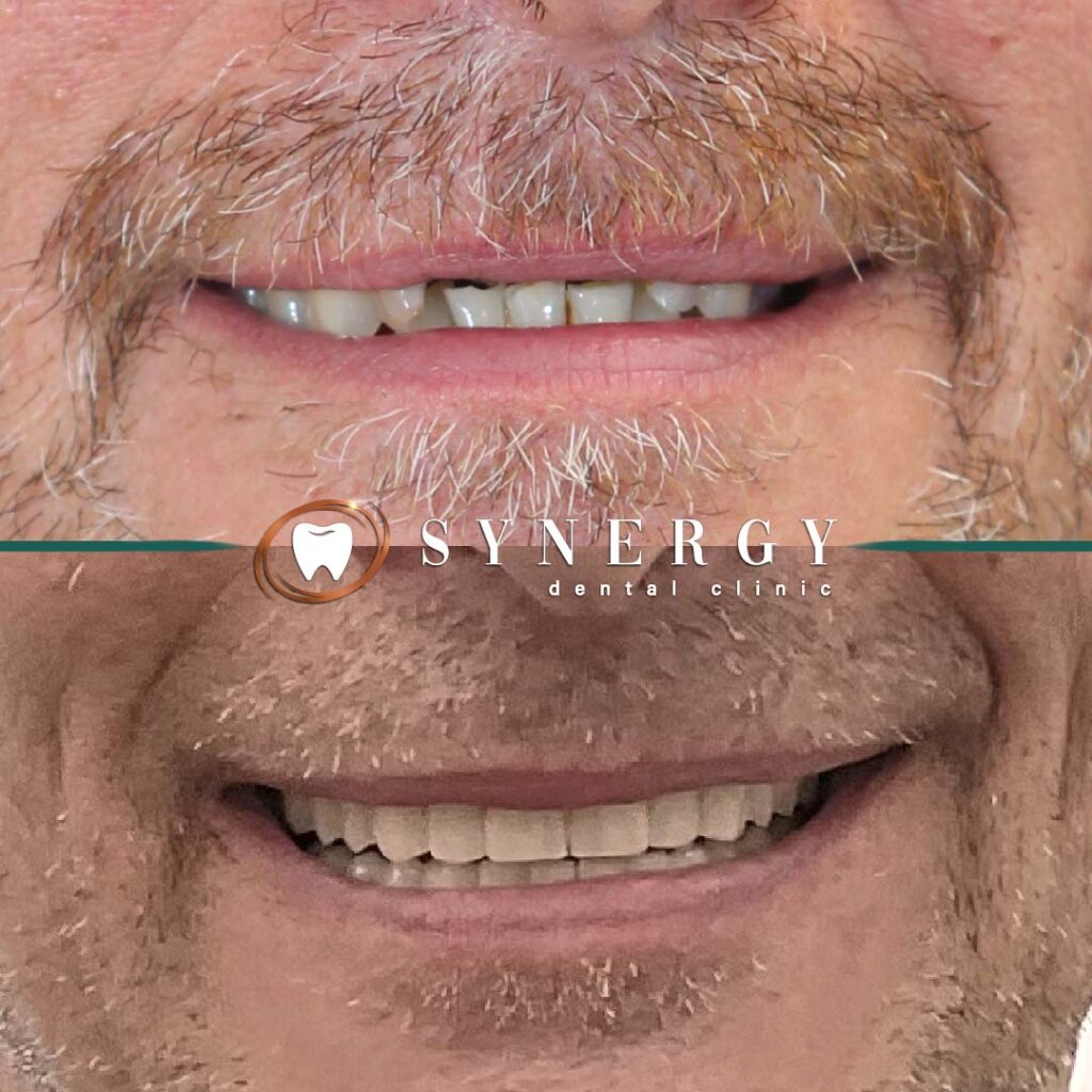 Same day implants 1011 • Synergy Dental Clinic