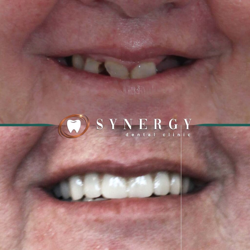 Same day implants 1007 • Synergy Dental Clinic