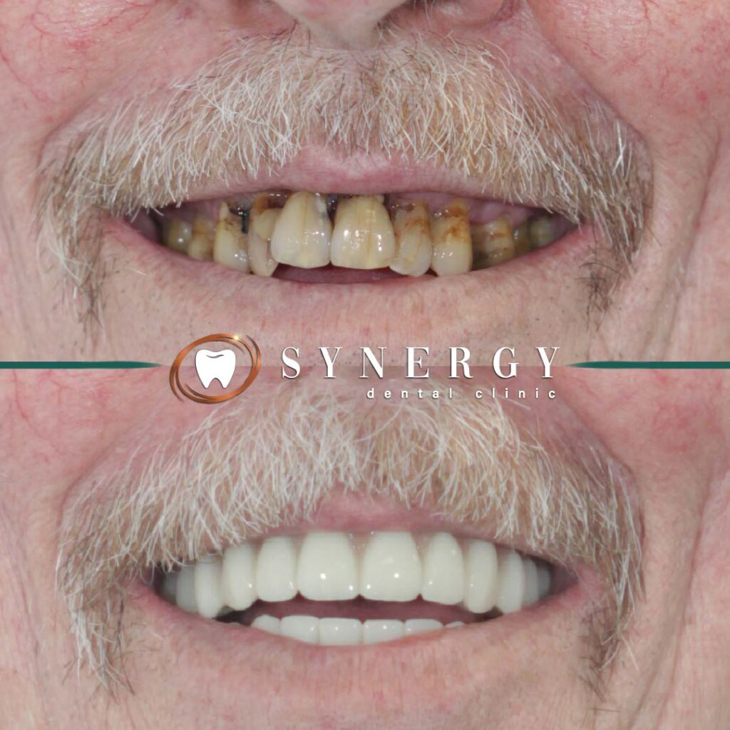 Same day implants 1002 • Synergy Dental Clinic