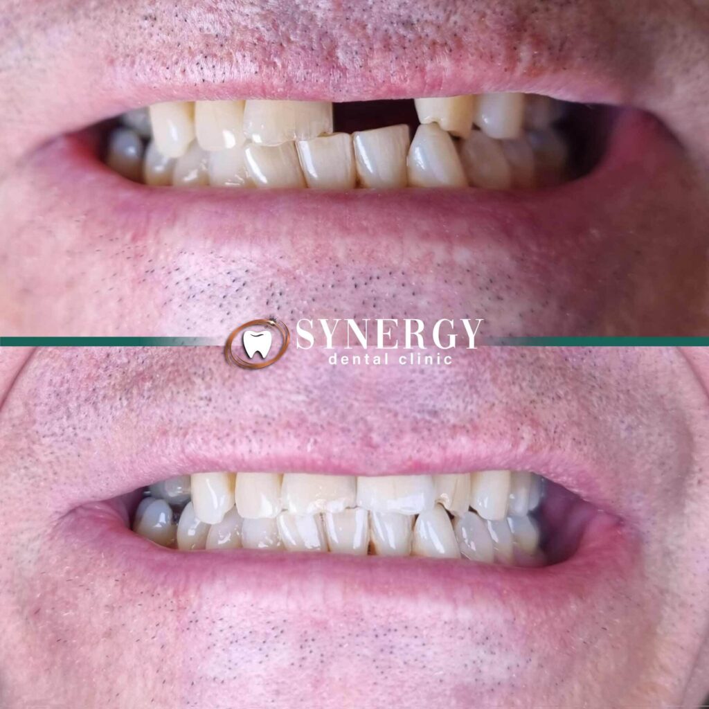 Single implant 935 • Synergy Dental Clinic