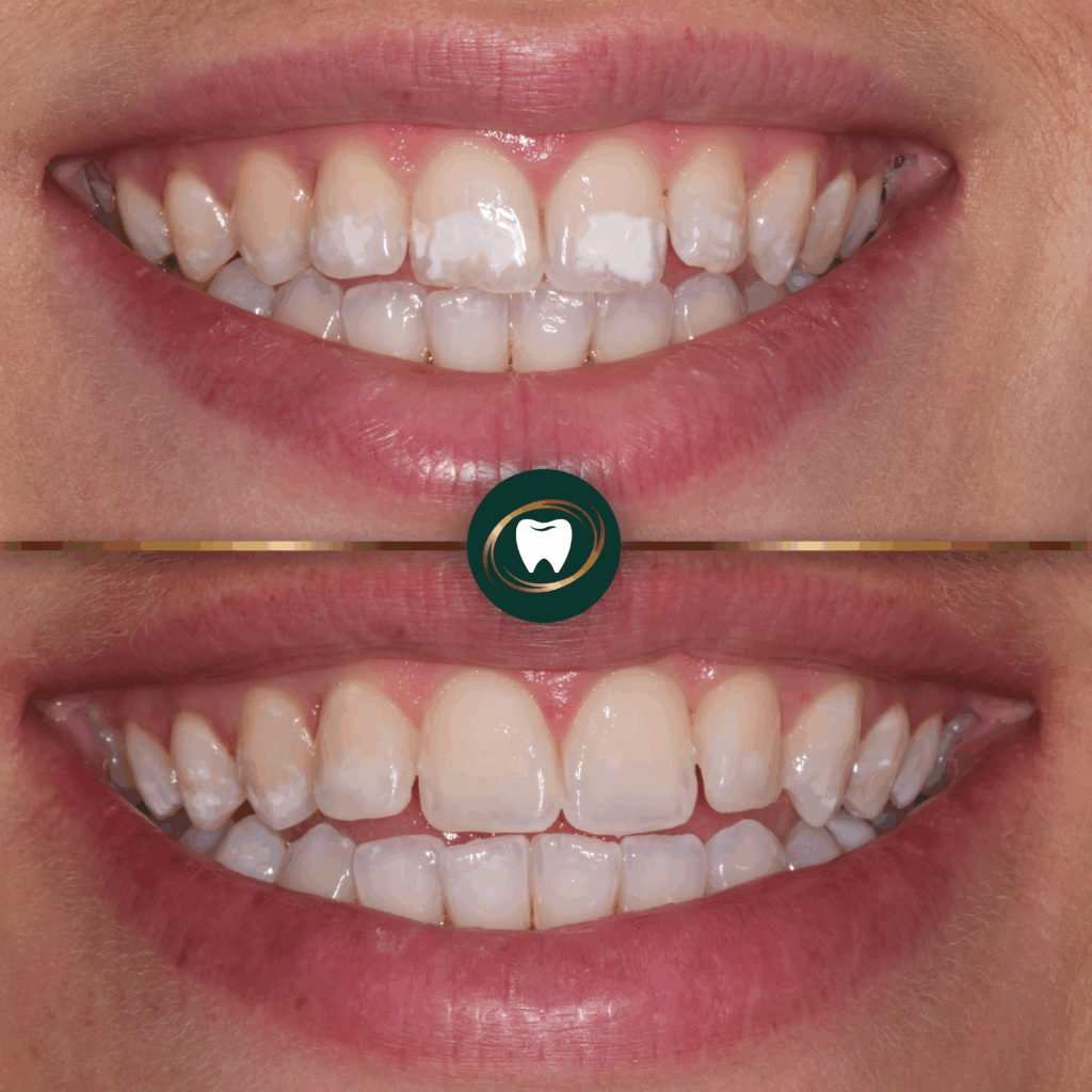 Composite bonding 1180 • Synergy Dental Clinic