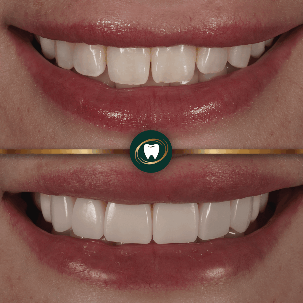 Composite bonding • Synergy Dental Clinic