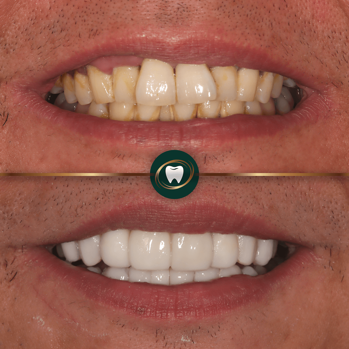 3D Printed Composite Veneers • Synergy Dental Clinic